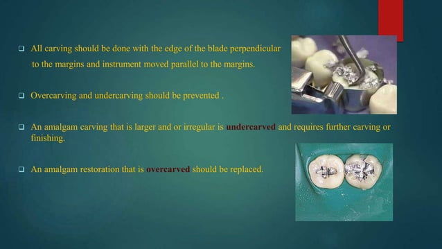 Class 1 and 2 amalgam tooth preparation. | PDF