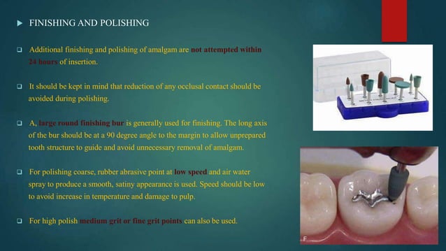 Class 1 and 2 amalgam tooth preparation. | PDF