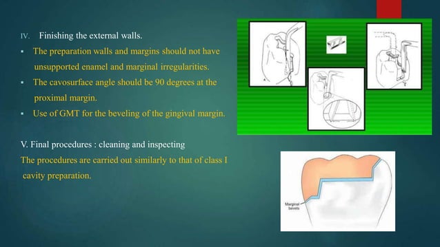 Class 1 and 2 amalgam tooth preparation. | PDF