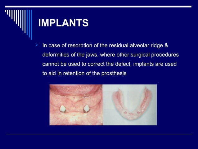 RETENTION IN COMPLETE DENTURE | PPT