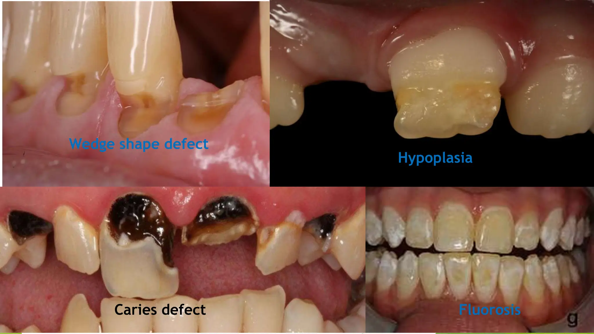 Etiology, clinical picture and treatment of pathology of hard tissues ...