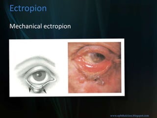 Lids and Adnexa Class 2 Part B - Lid malpositions | PPTX