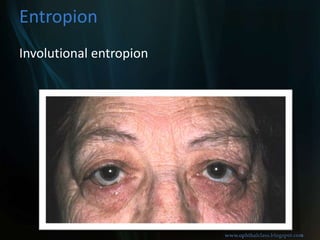 Lids and Adnexa Class 2 Part B - Lid malpositions | PPTX