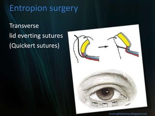 Lids and Adnexa Class 2 Part B - Lid malpositions | PPTX
