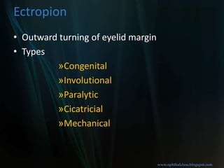 Lids and Adnexa Class 2 Part B - Lid malpositions | PPTX