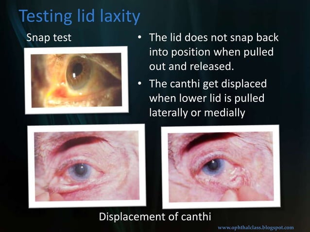 Lids and Adnexa Class 2 Part B - Lid malpositions | PPT
