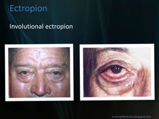 Lids and Adnexa Class 2 Part B - Lid malpositions | PPT