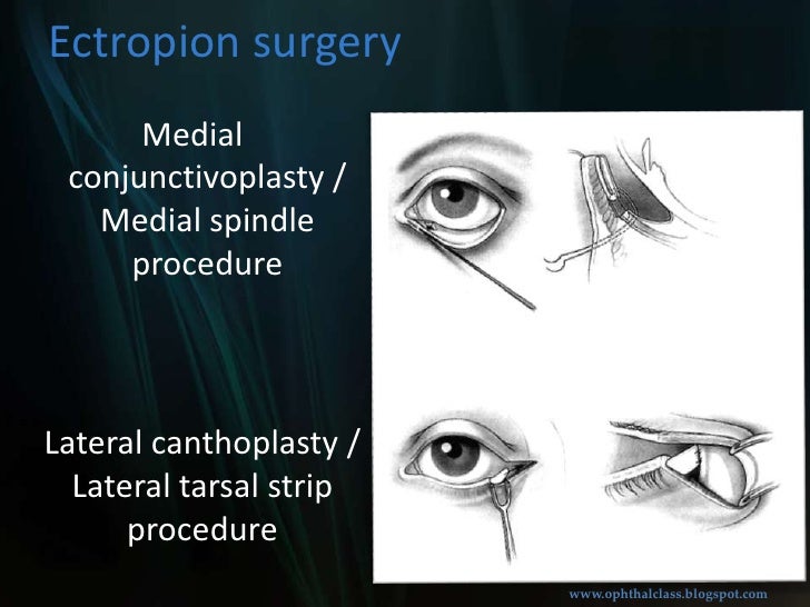 Lids and Adnexa Class 2 Part B - Lid malpositions