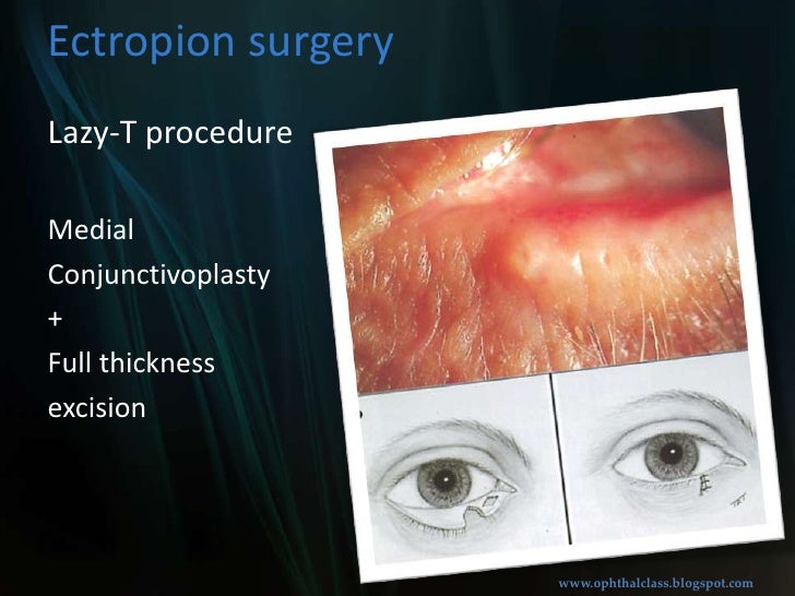 Lids And Adnexa Class 2 Part B Lid Malpositions