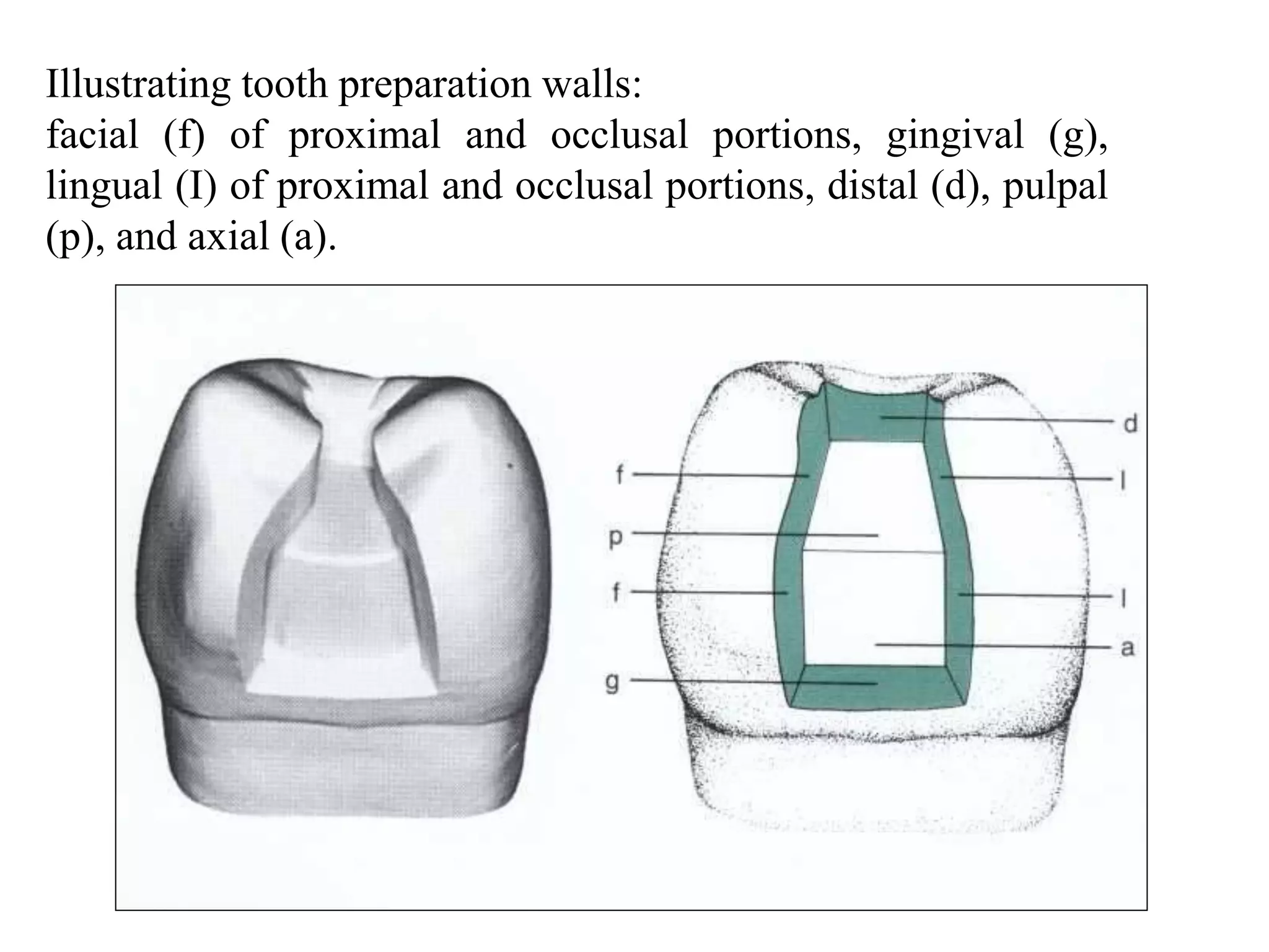 Class 2 amalgam restoration | PPTX