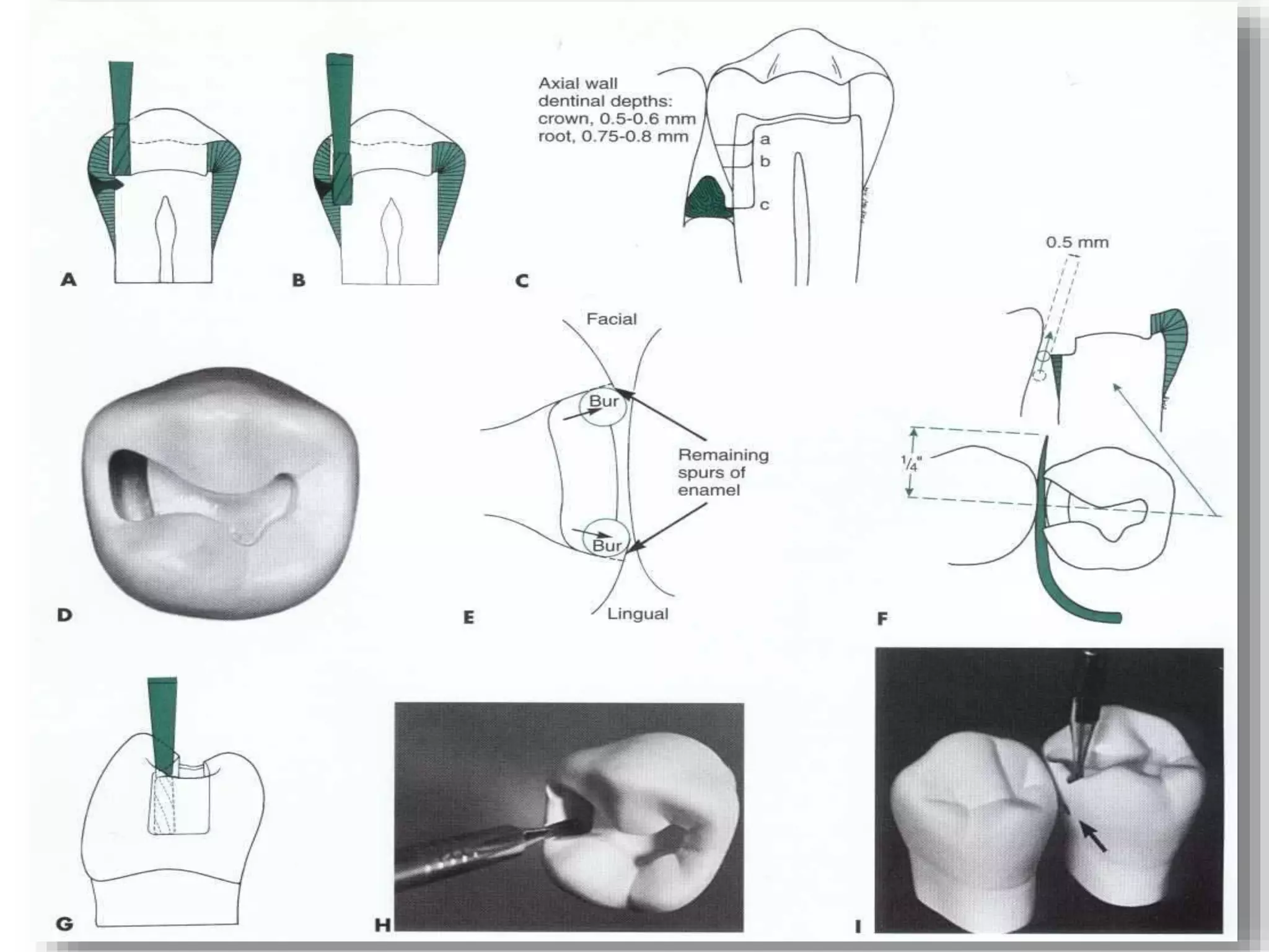 Class 2 amalgam restoration | PPTX