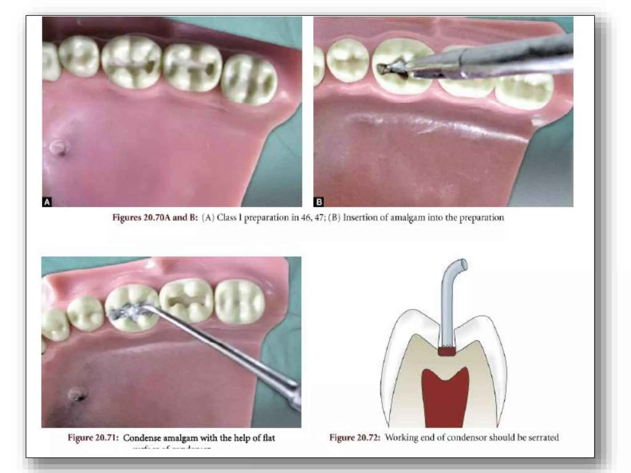 Class 2 amalgam restoration | PPTX