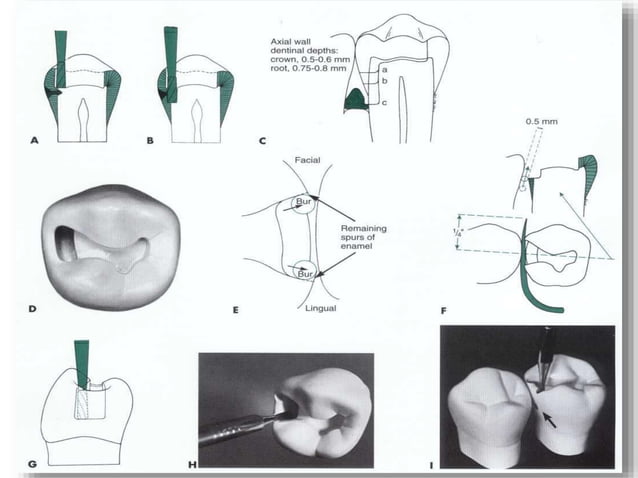 Class 2 amalgam restoration | PPTX