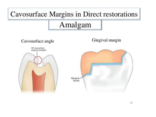 Class 2 amalgam restoration | PPTX