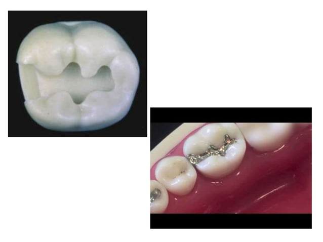 Class 2 amalgam restoration | PPTX