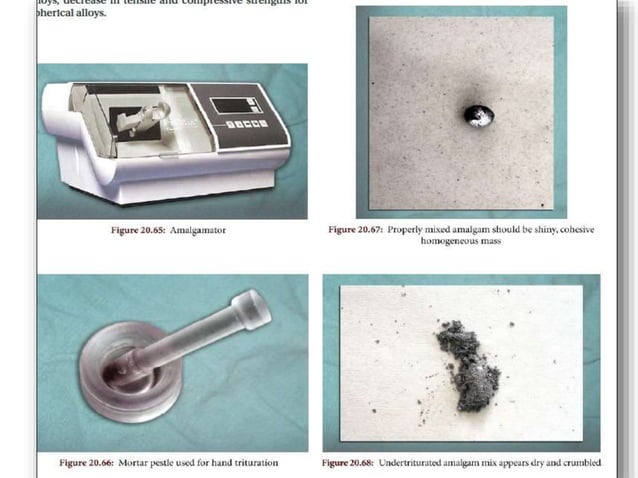 Class 2 amalgam restoration | PPTX