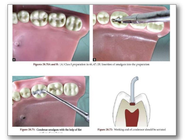 Class 2 amalgam restoration | PPTX