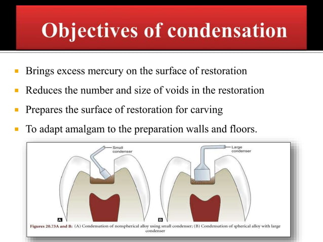 Class 2 amalgam restoration | PPTX