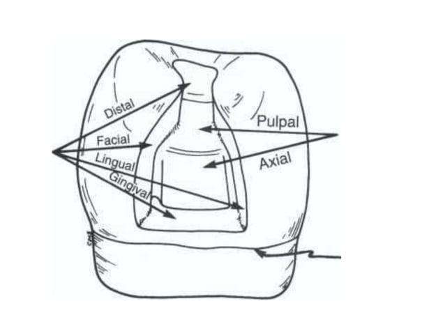 Class 2 amalgam restoration | PPTX