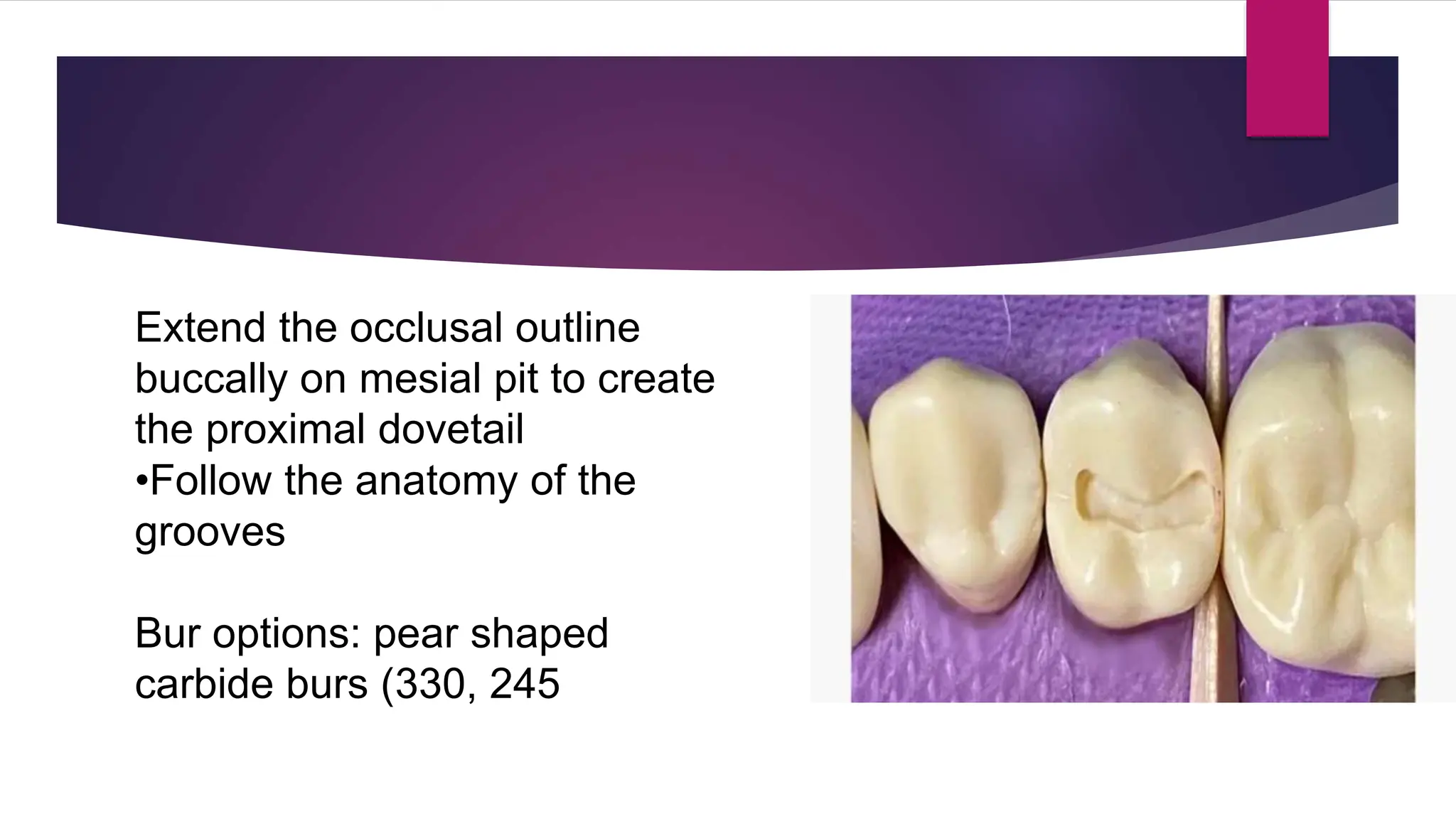 class two amalgam restoration in posterior teeth.pptx