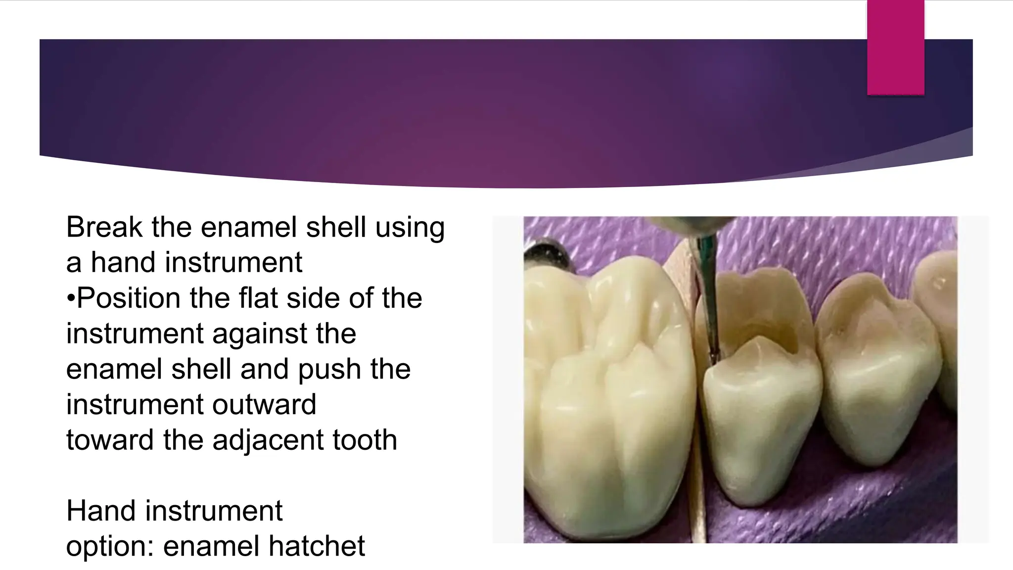 class two amalgam restoration in posterior teeth.pptx