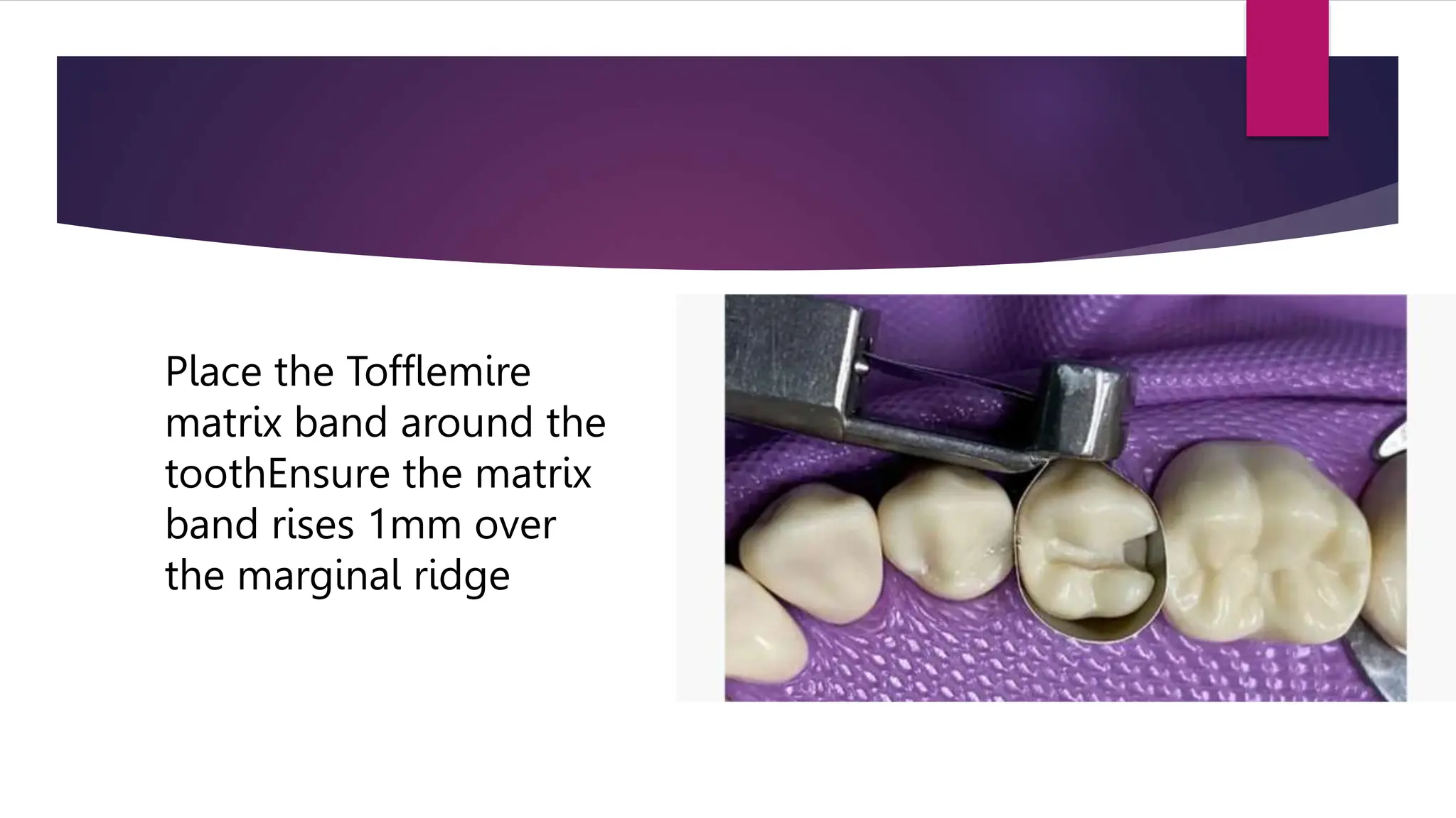 class two amalgam restoration in posterior teeth.pptx