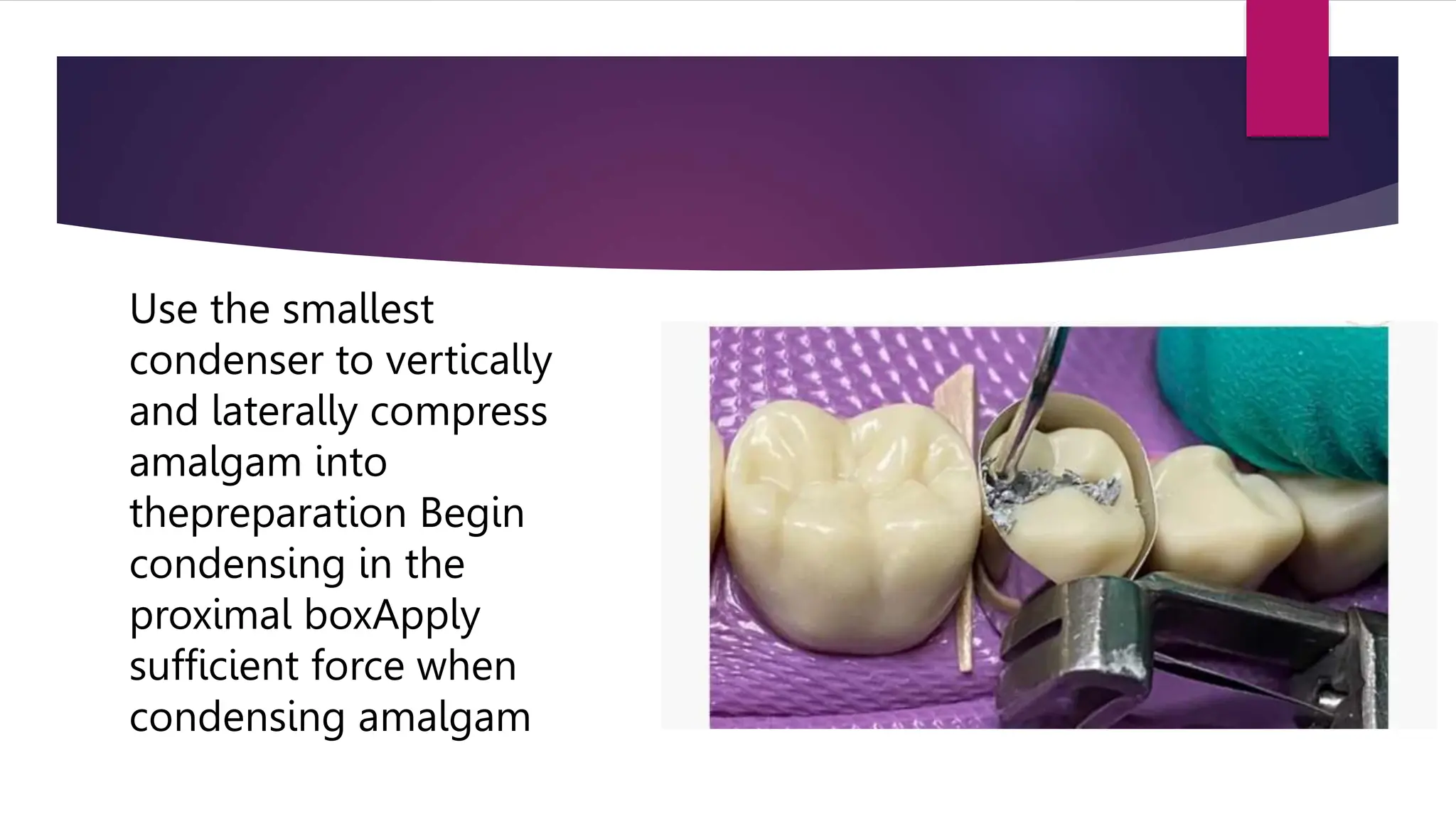 class two amalgam restoration in posterior teeth.pptx