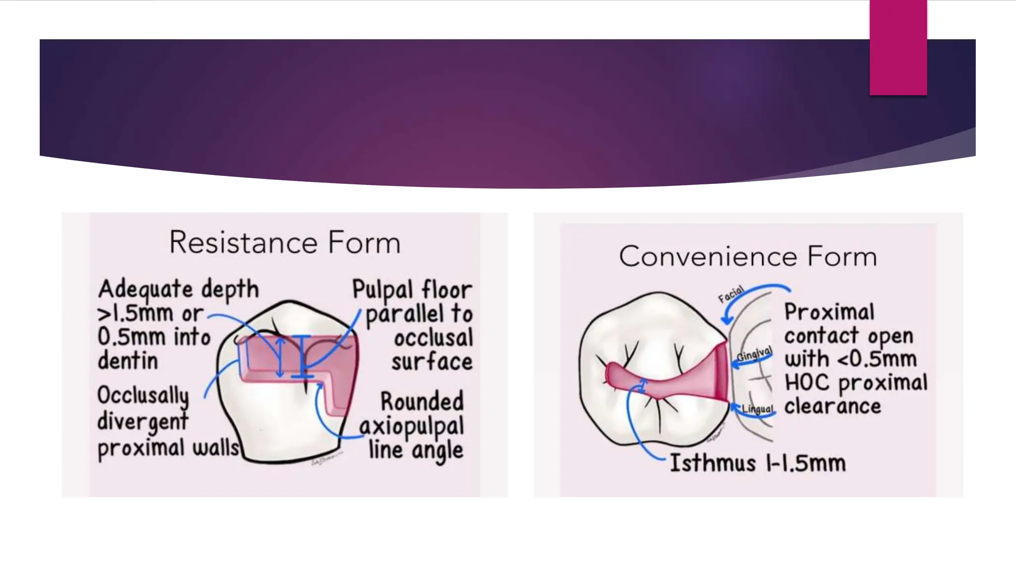 class two amalgam restoration in posterior teeth.pptx