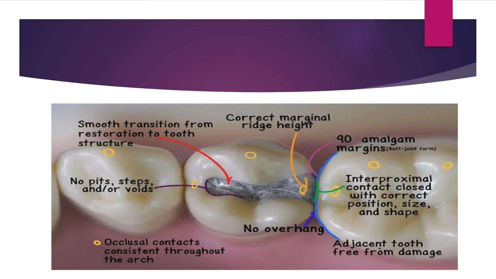 class two amalgam restoration in posterior teeth.pptx