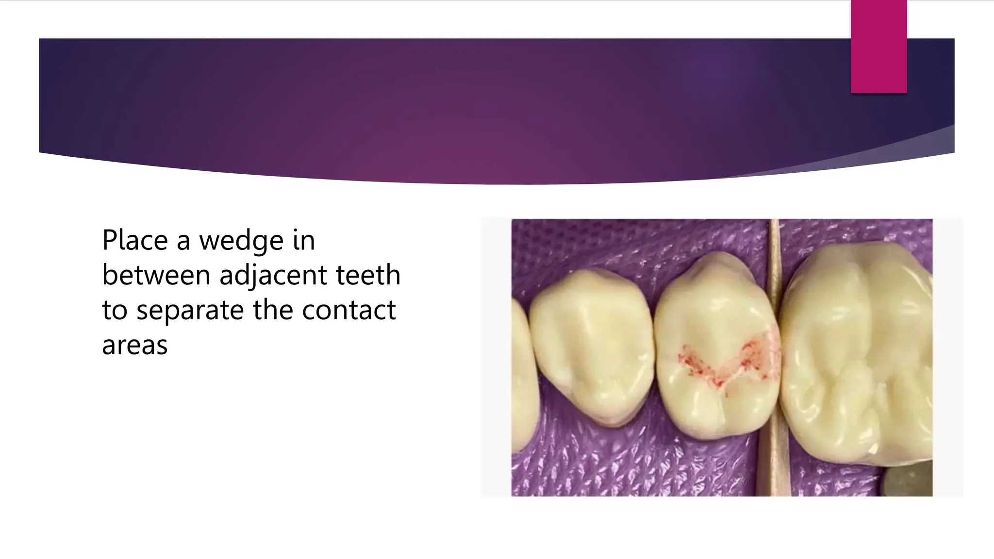 class two amalgam restoration in posterior teeth.pptx