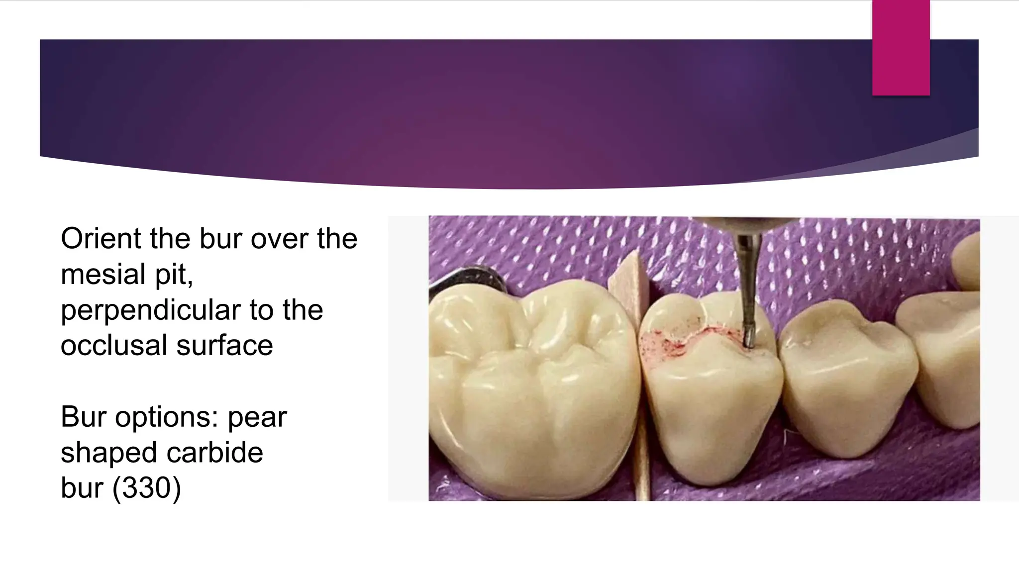 class two amalgam restoration in posterior teeth.pptx