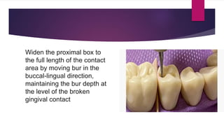 class two amalgam restoration in posterior teeth.pptx