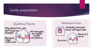 class two amalgam restoration in posterior teeth.pptx