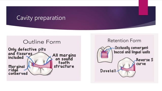 class two amalgam restoration in posterior teeth.pptx