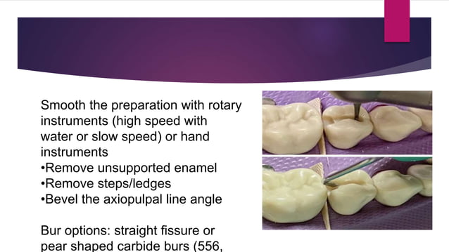 class two amalgam restoration in posterior teeth.pptx