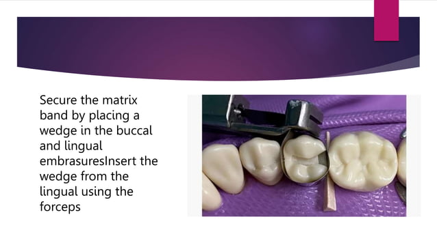 class two amalgam restoration in posterior teeth.pptx