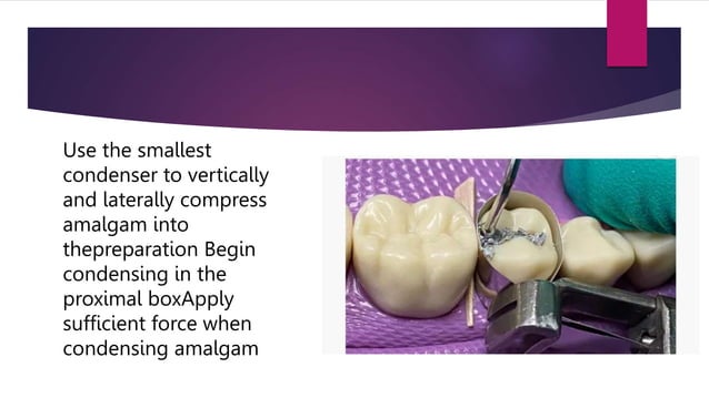 class two amalgam restoration in posterior teeth.pptx
