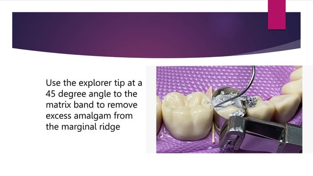 class two amalgam restoration in posterior teeth.pptx