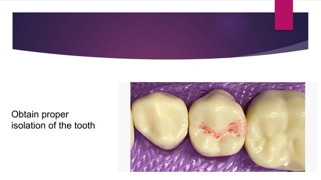 class two amalgam restoration in posterior teeth.pptx