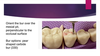 class two amalgam restoration in posterior teeth.pptx