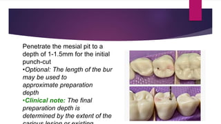 class two amalgam restoration in posterior teeth.pptx