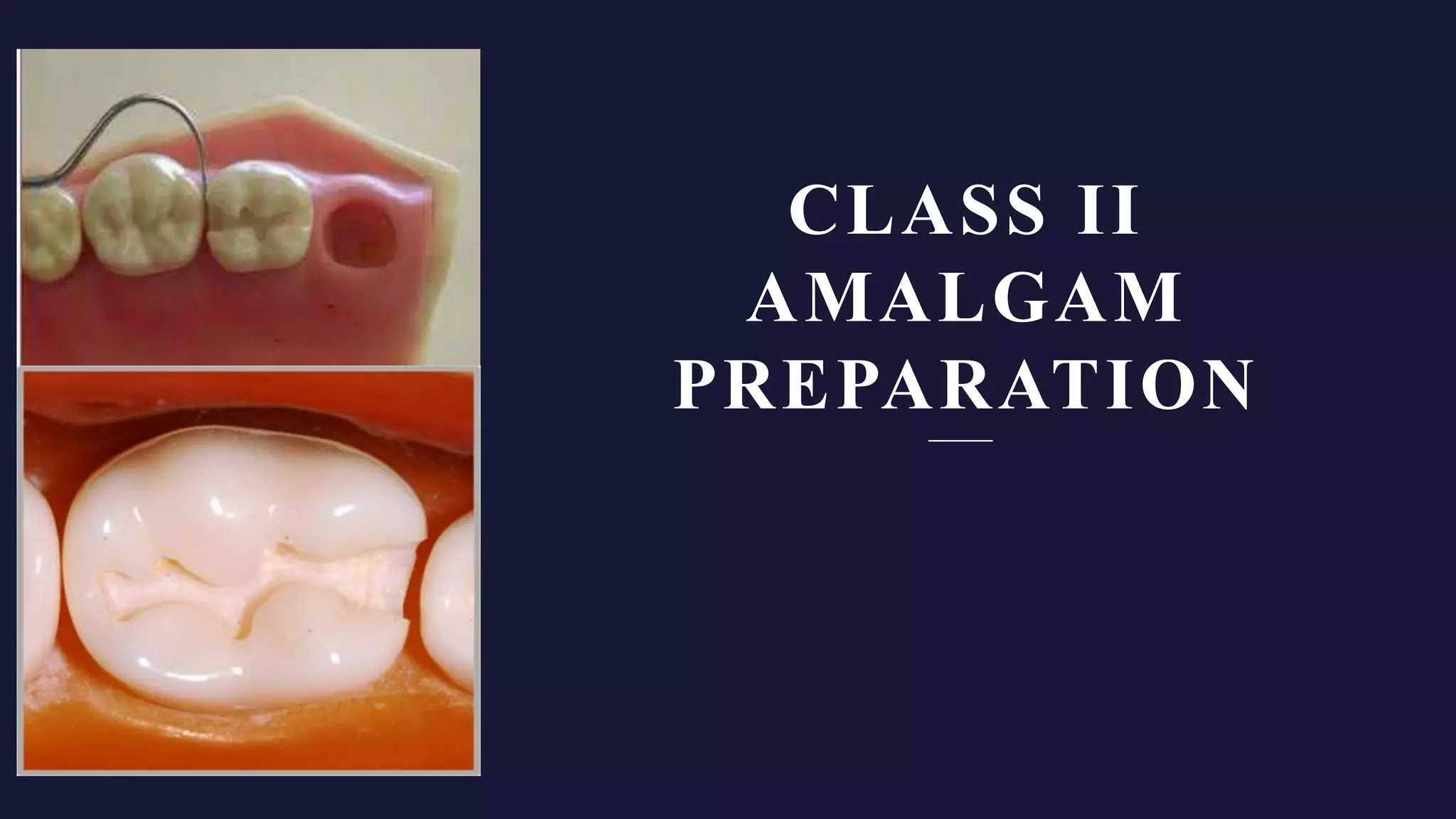 Class 2 cavity amalgam | PPTX