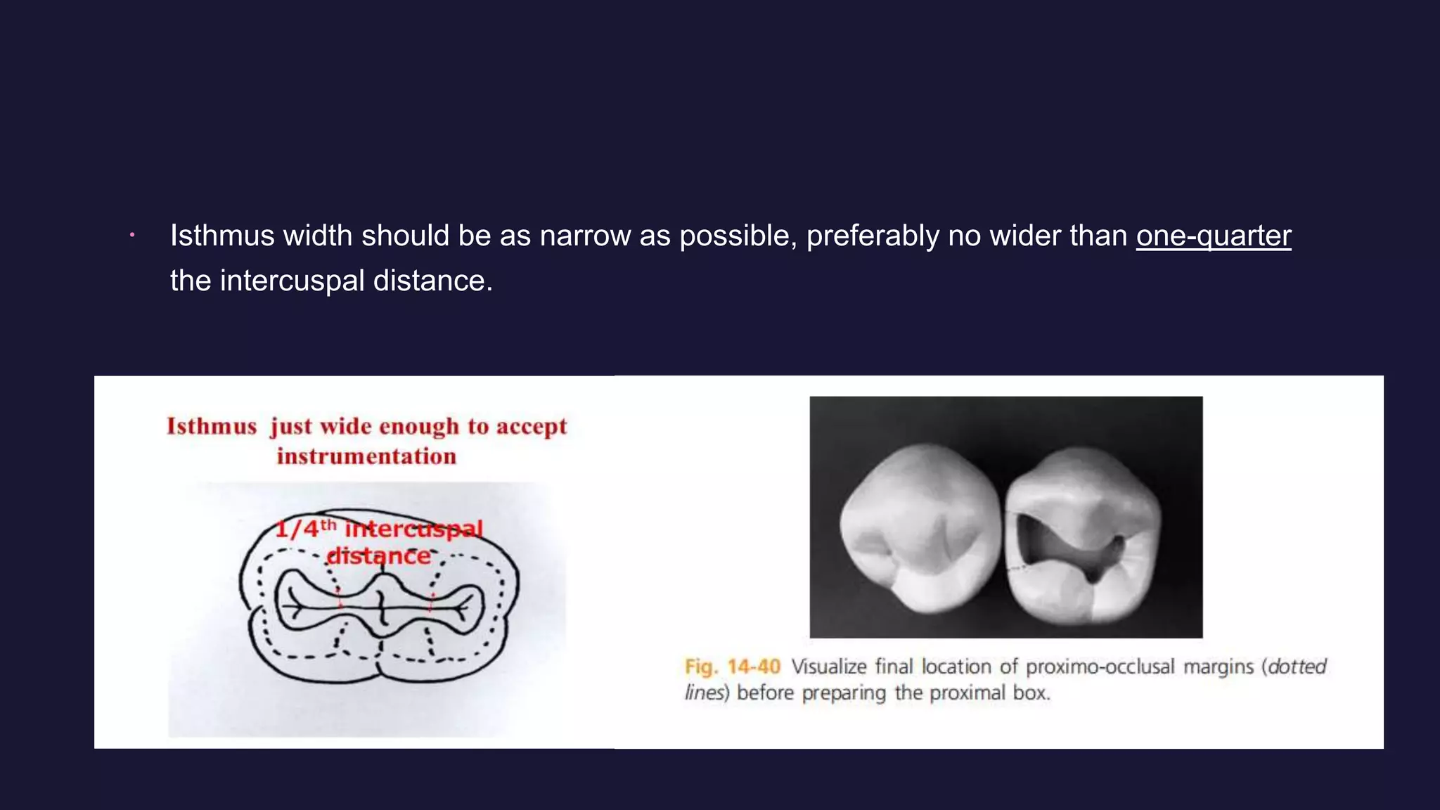 Class 2 cavity amalgam | PPTX