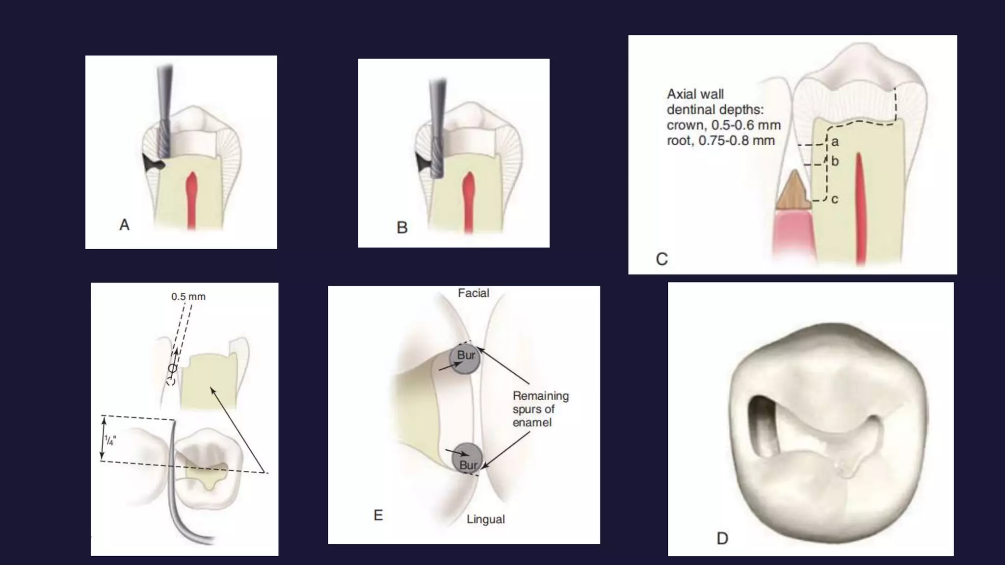 Class 2 cavity amalgam | PPTX