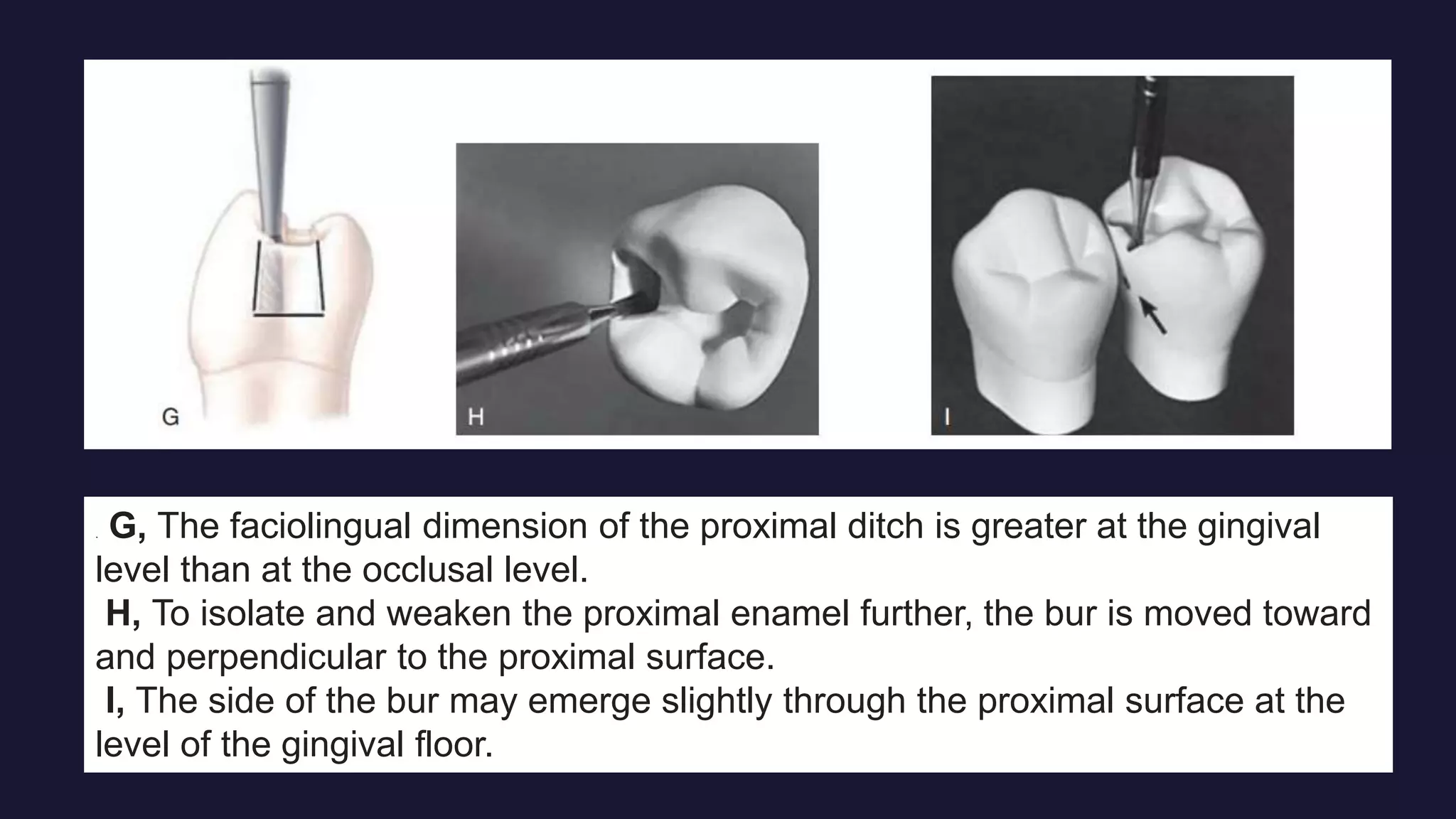 Class 2 cavity amalgam | PPTX