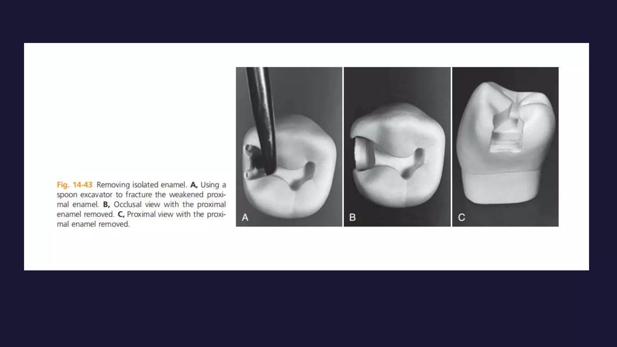 Class 2 cavity amalgam | PPTX