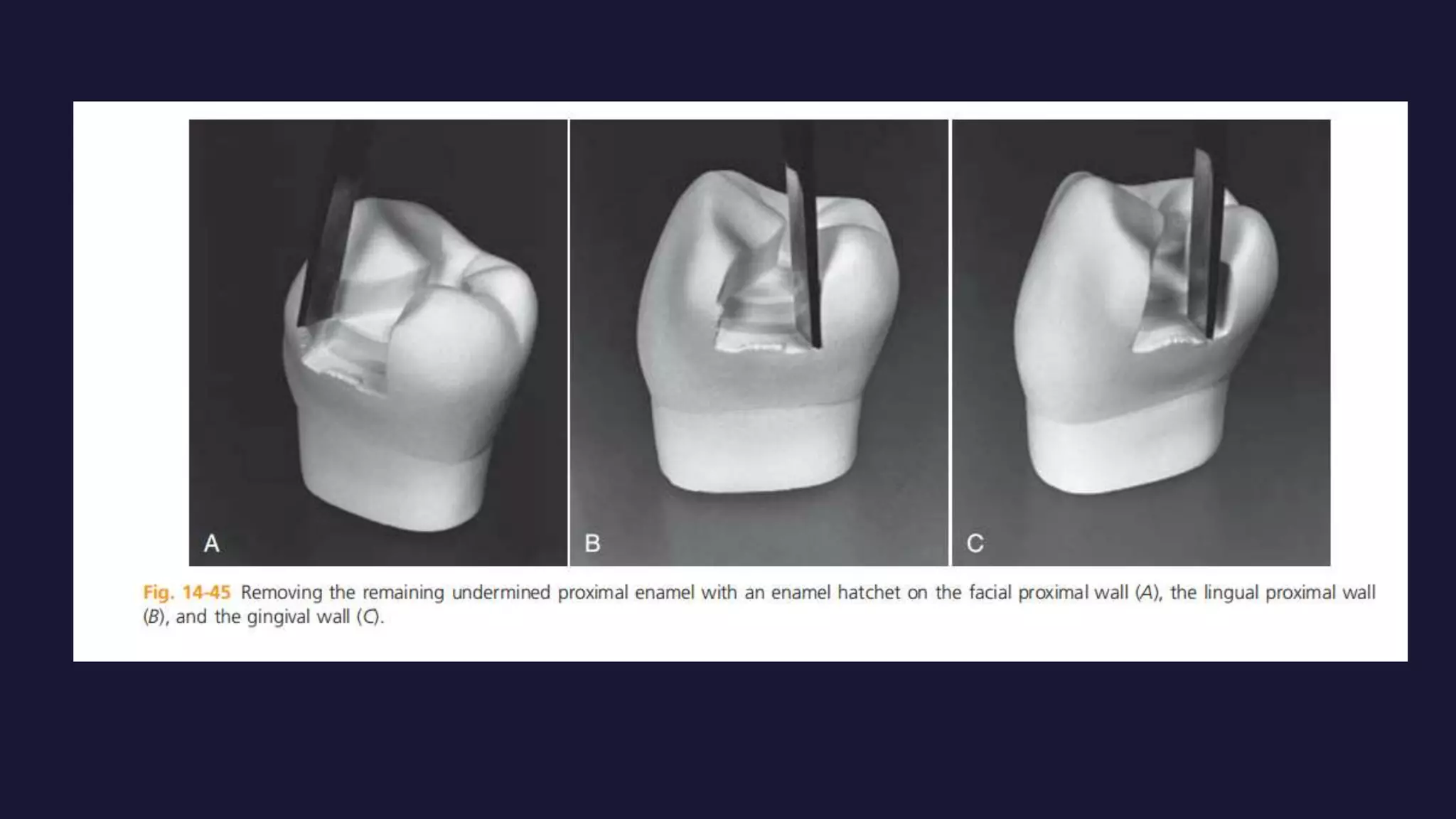 Class 2 cavity amalgam | PPTX