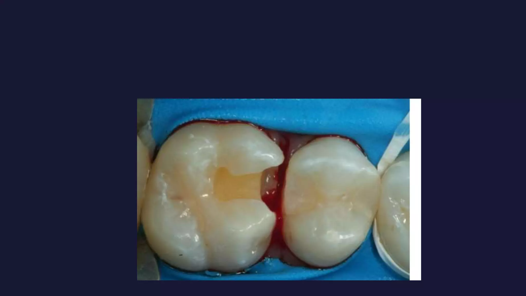 Class 2 cavity amalgam | PPTX