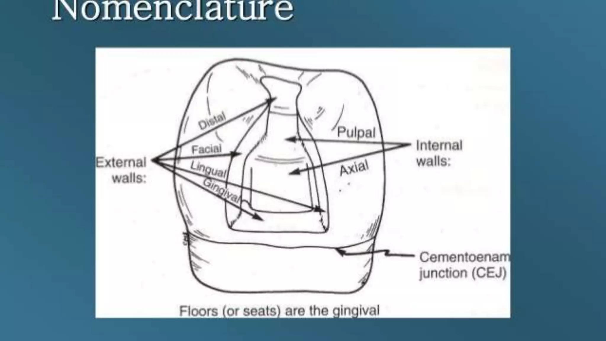 Class 2 cavity amalgam | PPTX