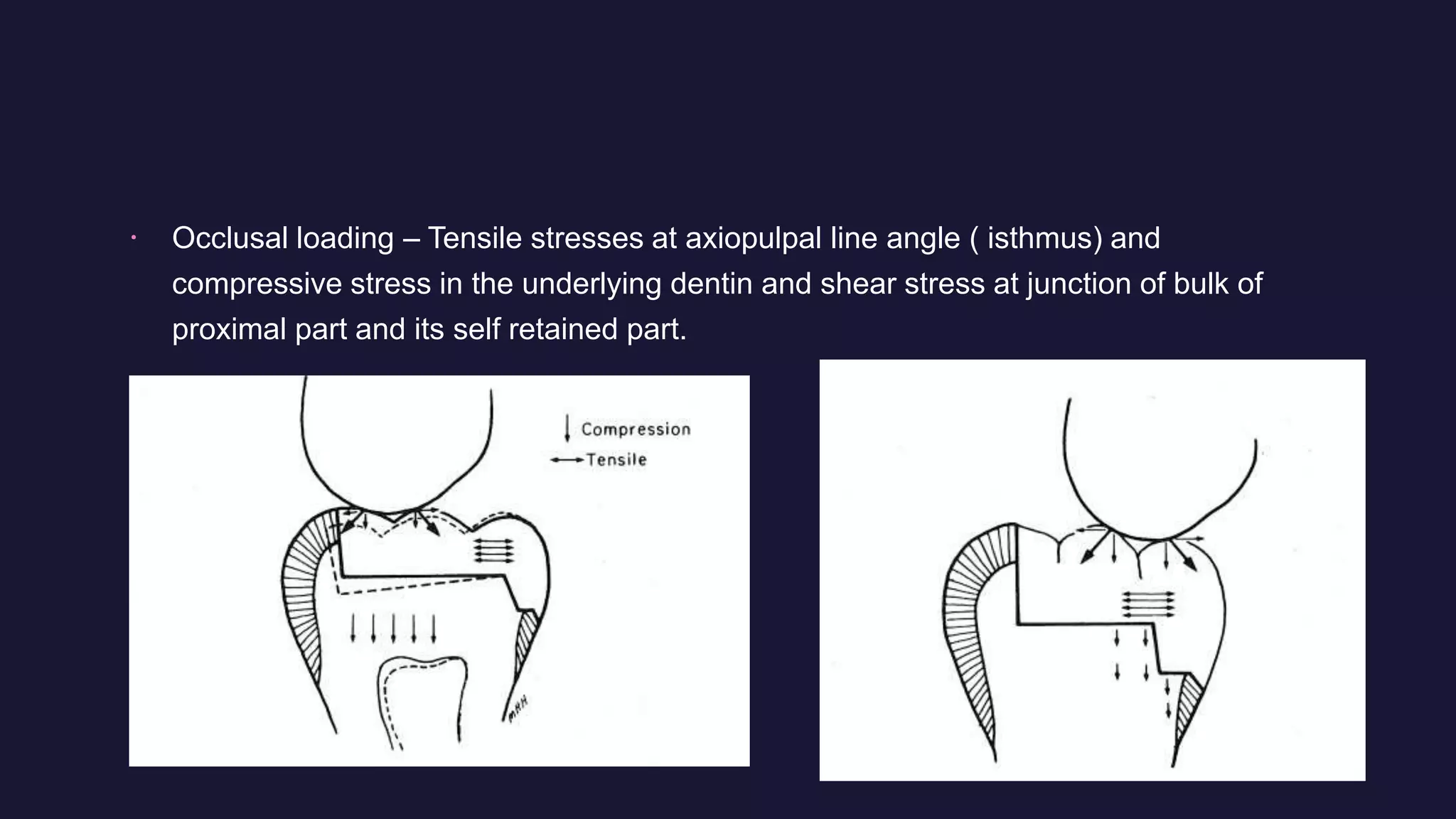 Class 2 cavity amalgam | PPTX